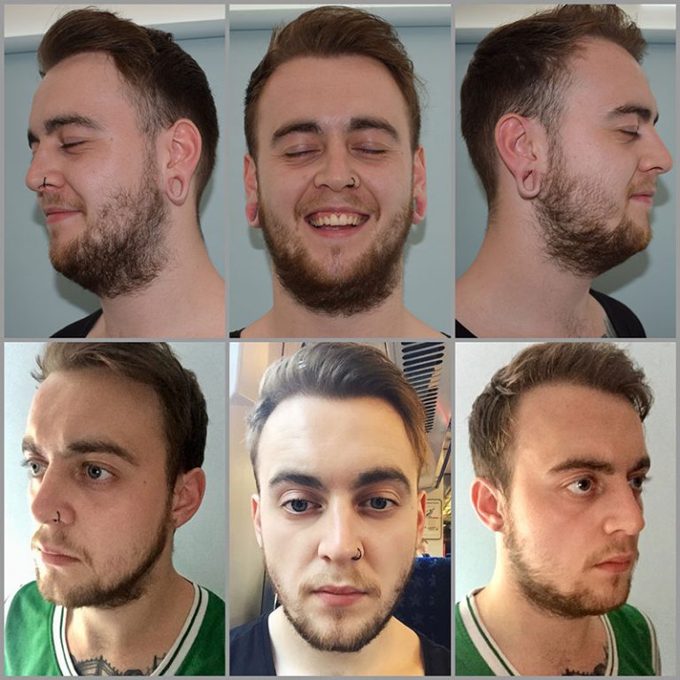 Tribal lobe repair surgery, Earlobe Reduction London, Split/Stretched ...