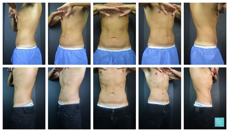 CoolSculpting for Men upper, lower abdomen before after results, Fat ...