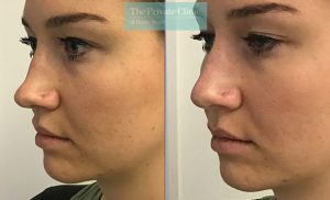 Dermal Fillers - Before & After Images - The Private Clinic of Harley ...