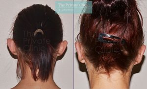 Ear Reshaping - Before & After Images - The Private Clinic of Harley ...