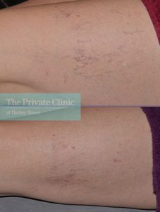 Thread Veins Removal - Before & After Images - The Private Clinic of ...