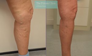 Varicose Veins Removal - Before & After Images - The Private Clinic of ...