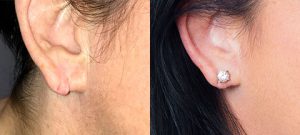 Split Earlobe Repair, Stretched Ear Lobes Sonia patient story and ...