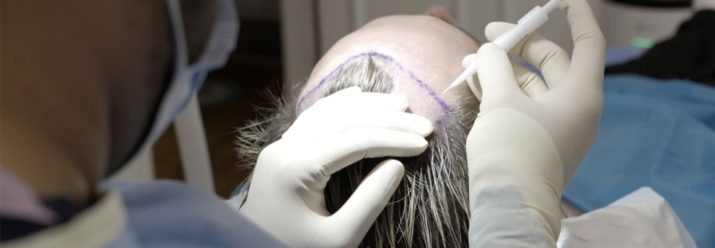Hair Transplant, Hair Restoration Surgery at UK Hair Transplant Clinics