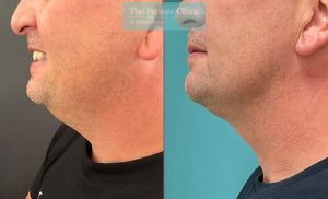 Micro Lipo - 001L-MM - The Private Clinic of Harley Street London