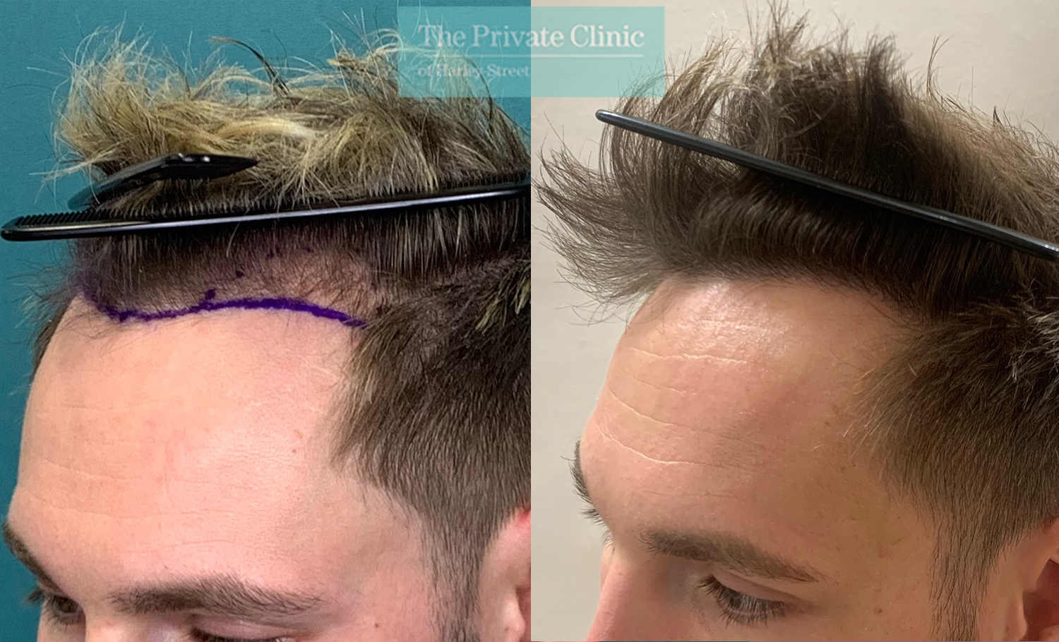 FUE Hair Transplant - Ash, 11 Months after Hair Transplant Before After ...