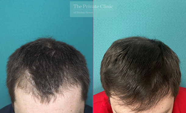 Hair Transplant How Many Hair Grafts For Hair Coverage 500 3000