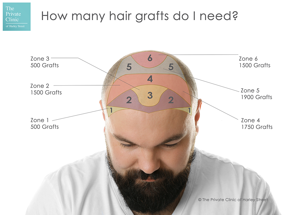 Hair Transplant How Many Hair Grafts For Hair Coverage 500 3000