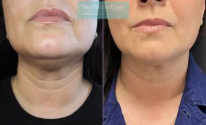 Micro Lipo - 013L-MM - The Private Clinic of Harley Street London