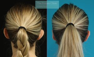 Otoplasty (Ear Pinning Surgery) Prices, Pin Ears Back Surgery Cost