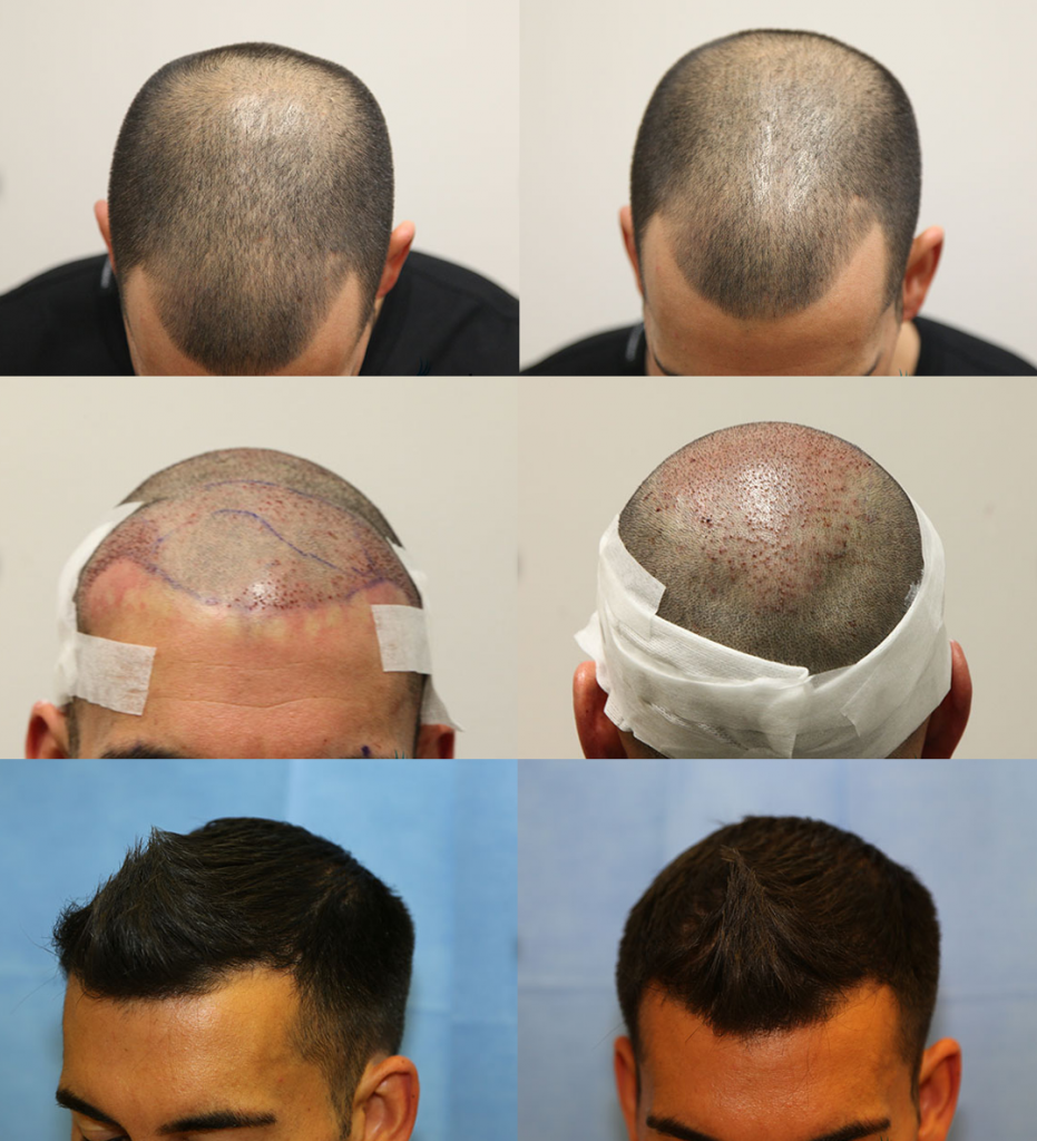 Hair Transplant, 3 Months Post Surgery, Results Before and After Hair Transplant