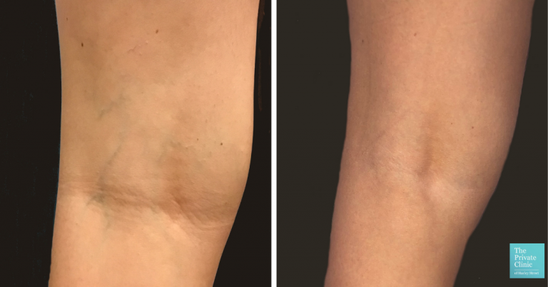 How do I get rid of spider veins on my legs, Best Treatment Thread Vein ...