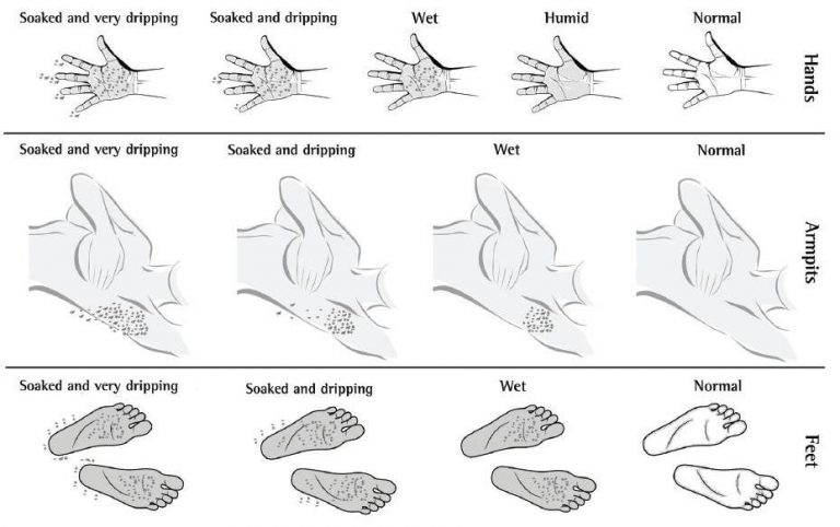 Hyperhidrosis Excessive Sweating Treatment for Men, Women | armpit ...