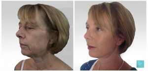 Facelift Surgery Clinic, London Facial Plastic Surgeon‎, Expert ...