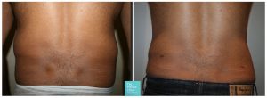 Love Handles Before and After Photos, Non-Surgical treatment for love ...