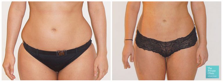 Love Handles Before and After Photos, Non-Surgical treatment for love handles reduction